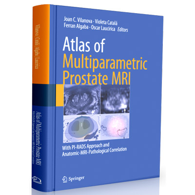 Atlas of Multiparametric Prostate MRI With PI-RADS Approach and Anatomic-MRI-Pathological ...