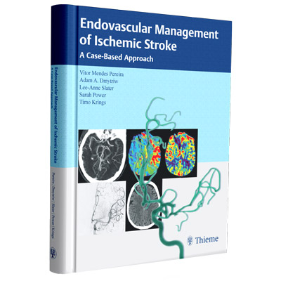Endovascular Management of Ischemic Stroke: A Case-Based Approach ...